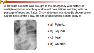 Intestinal Obstruction - Types, C/F & Management | PDF