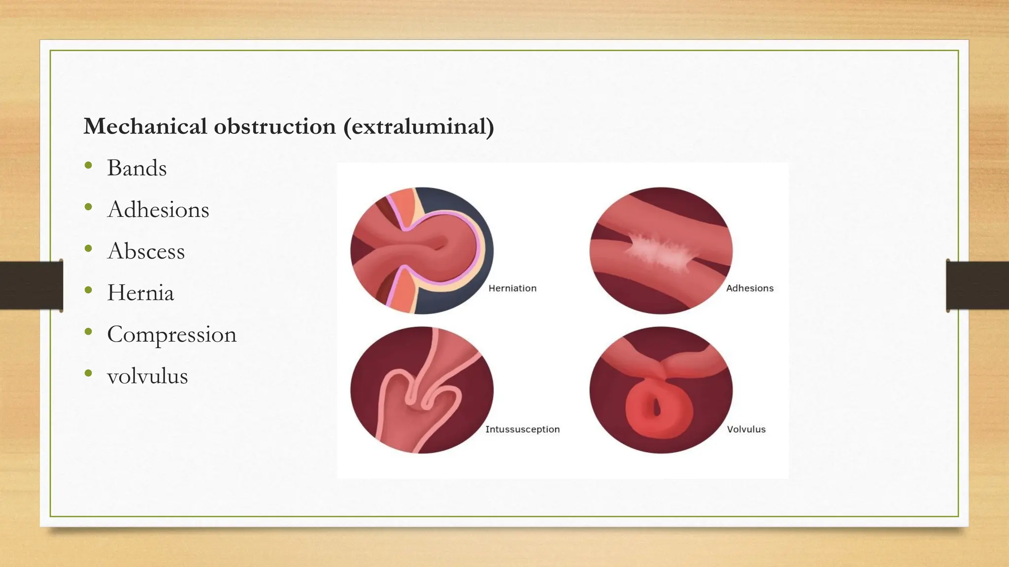 A Slide on INTESTINAL or bowel OBSTRUCTION.pptx