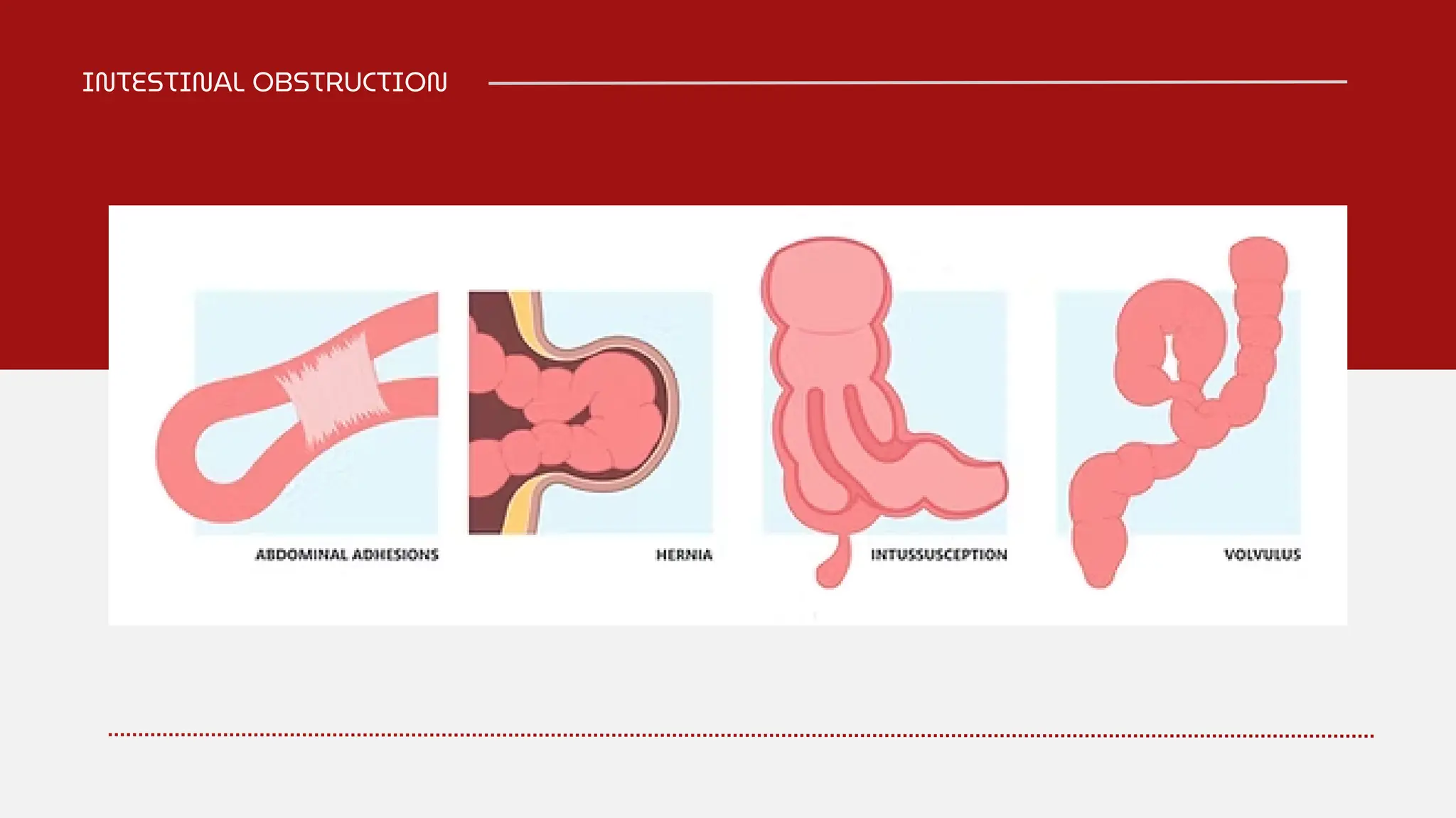 INTESTINAL OBSTRUCTION.pdf. health companion | PDF
