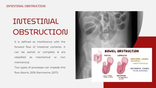 INTESTINAL OBSTRUCTION.pdf. health companion | PPT