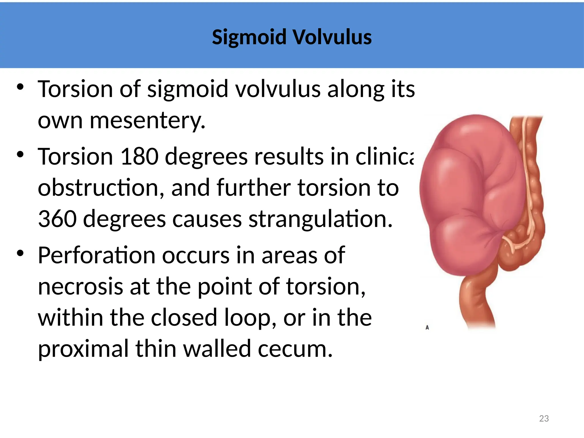 Intestinal obstruction is one of the most important part of long case ...
