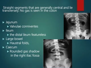 Intestinal obstruction | PPTX