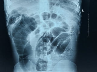 Approach to a patient with intestinal obstruction | PPT