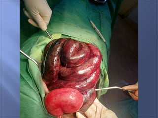 Approach to a patient with intestinal obstruction | PPT