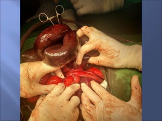 Approach to a patient with intestinal obstruction | PPT