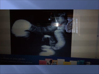 intestinal obstruction notes surgical department | PPT