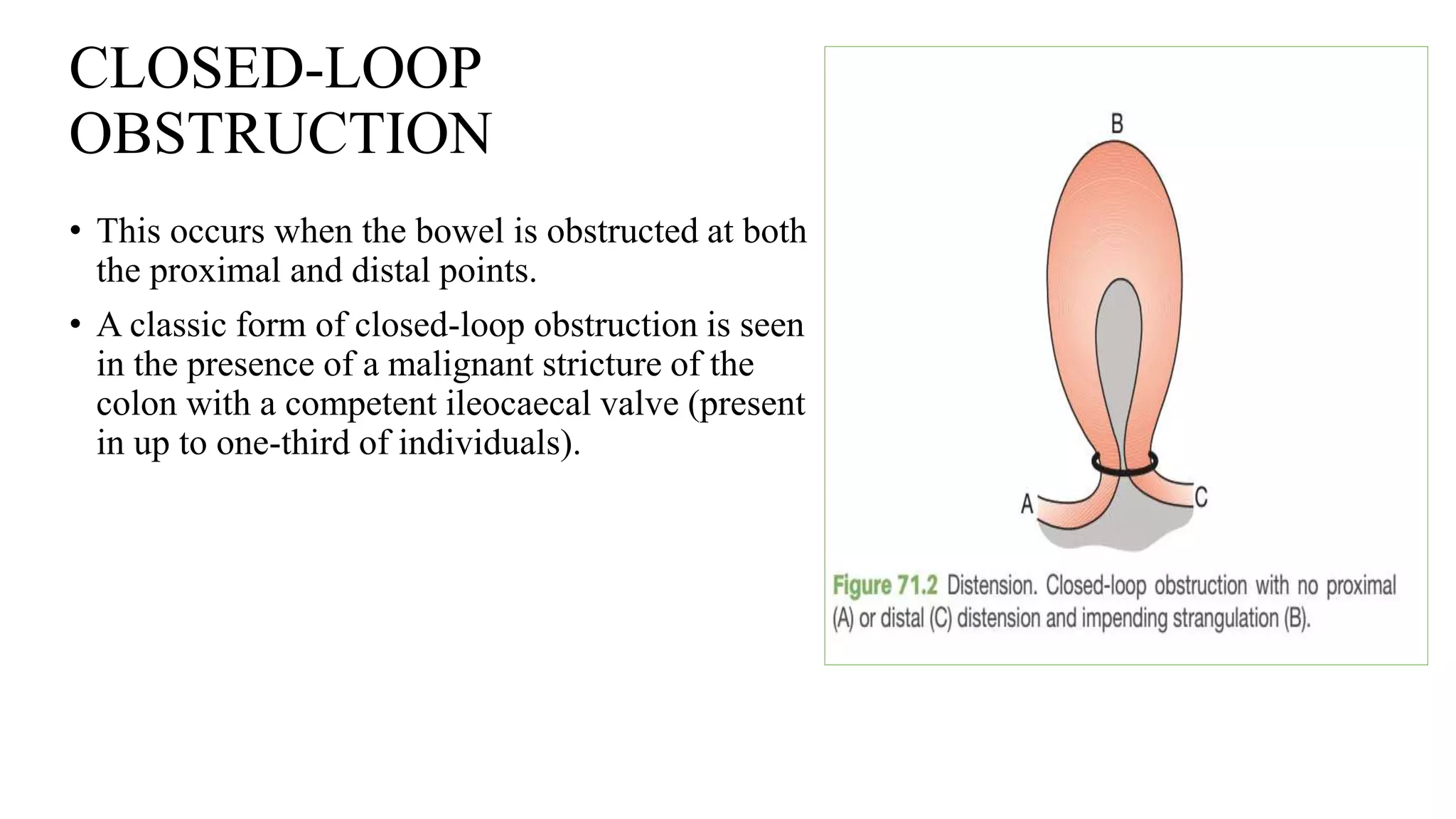 Intestinal Obstruction | PPTX