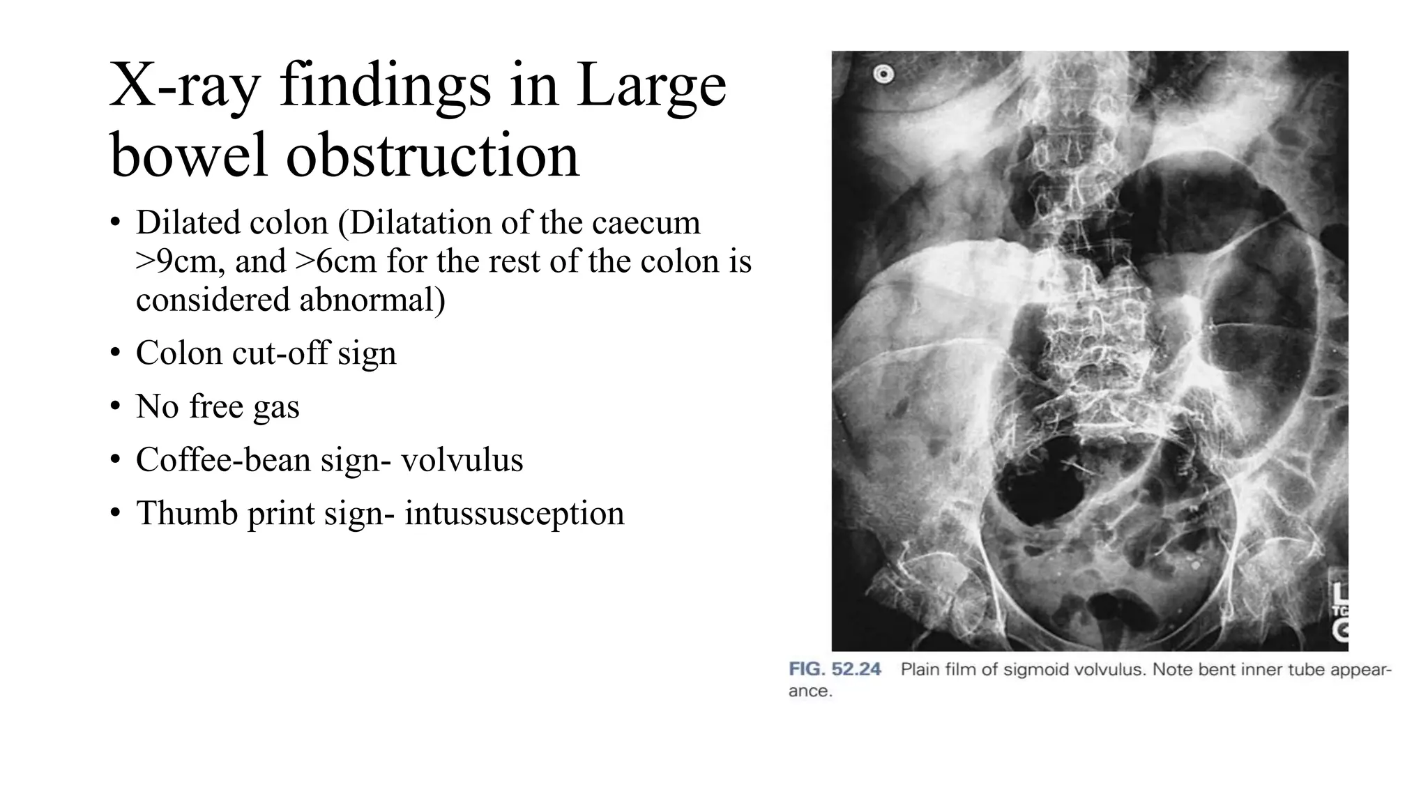 Intestinal Obstruction | PPTX