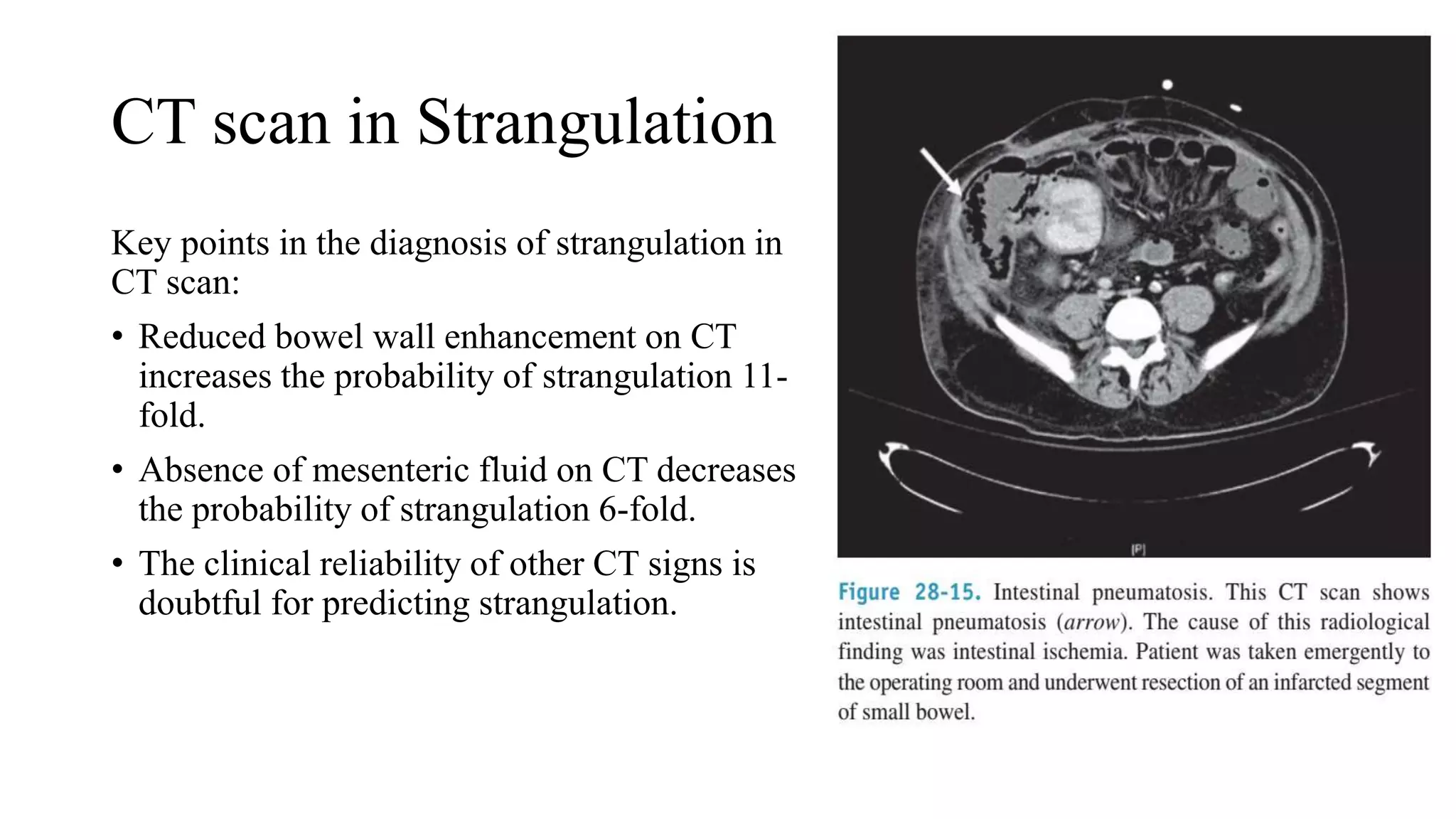 Intestinal Obstruction | PPTX