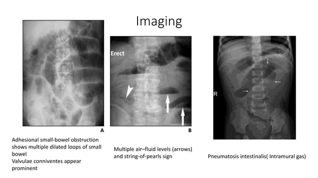 Intestinal Obstruction | PPTX