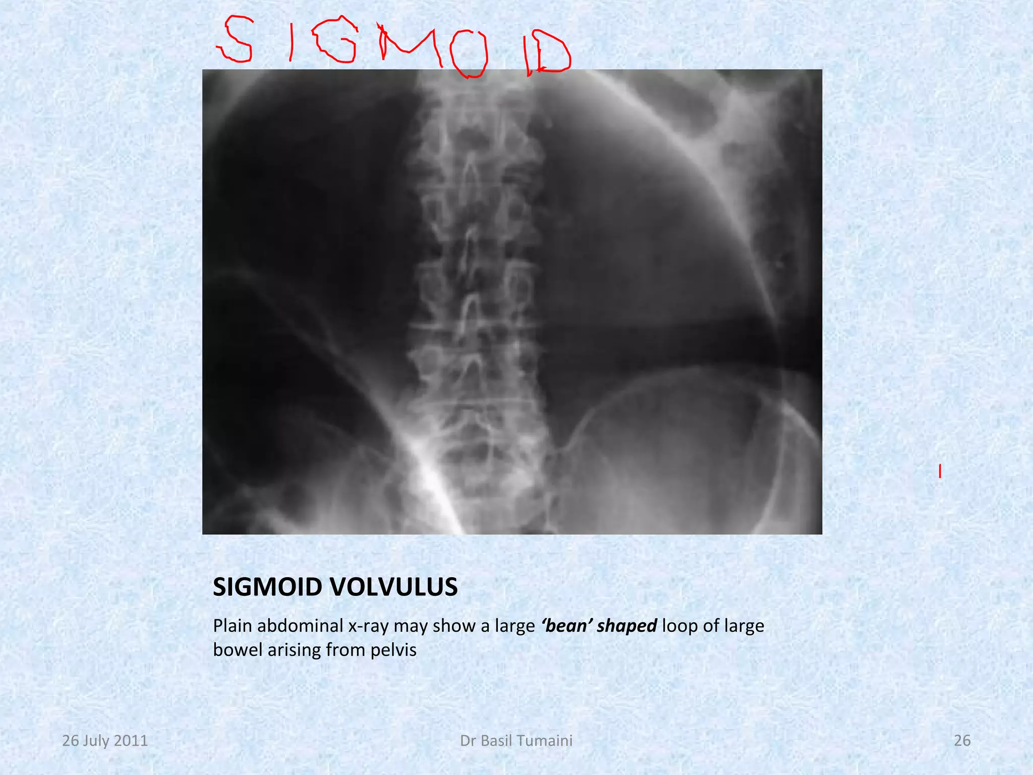 Intestinal obstruction caused by volvulus by dr basil | PPT