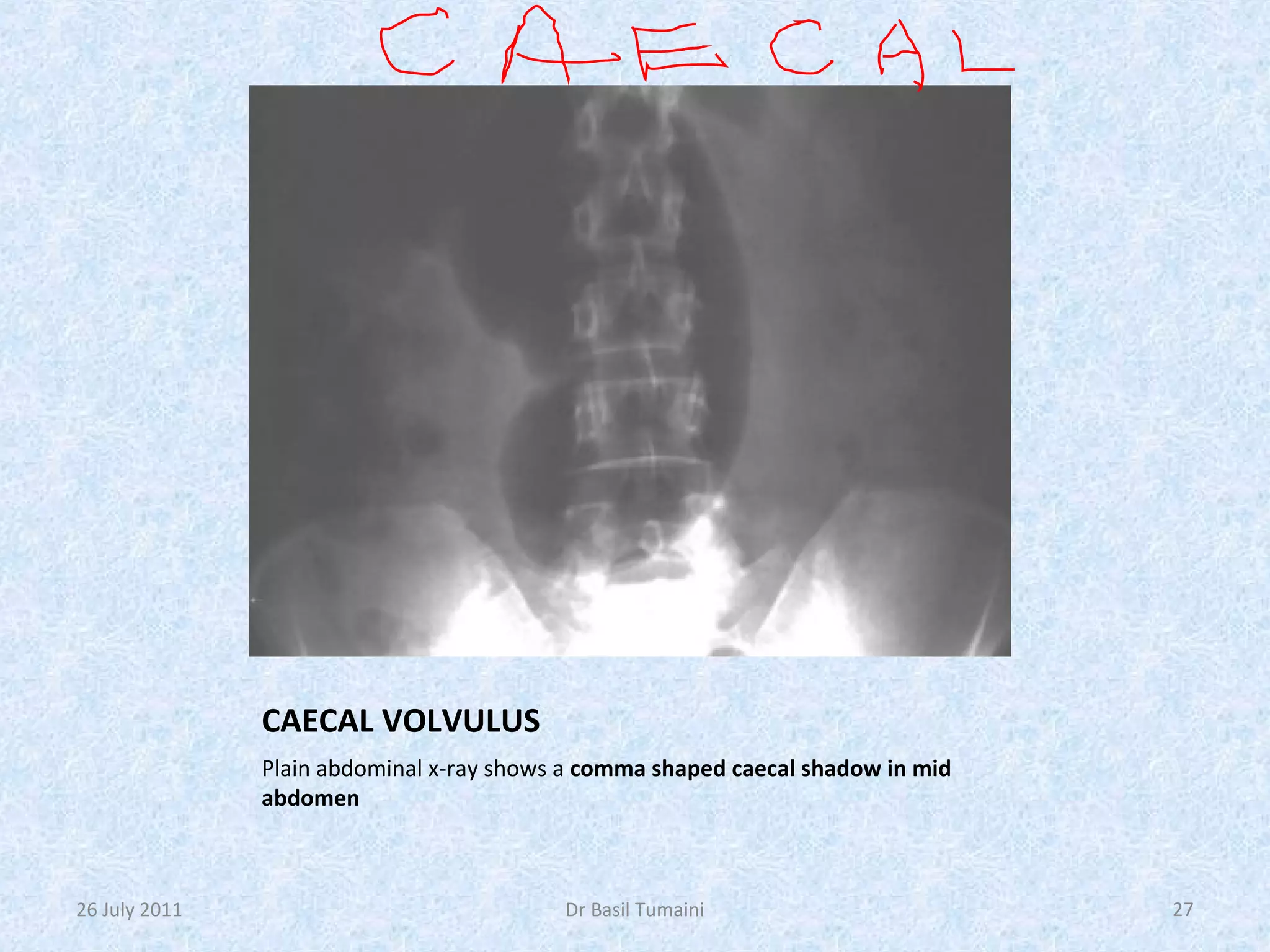 Intestinal obstruction caused by volvulus by dr basil | PPT