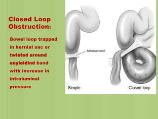 DIAGNOSIS AND MANAGMENT OF INTESTINAL OBSTRUCTION BY DR. MOH.HAZEM ...