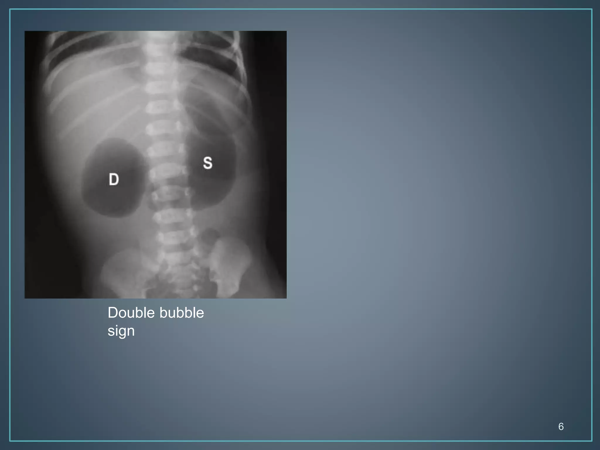 Intestinal obstruction in paeds | PPTX