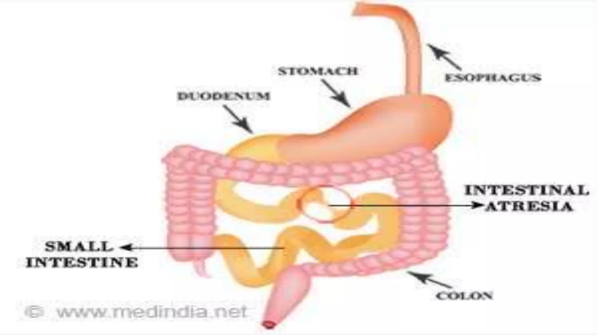 Intestinal obstruction, BOWEL OBSTRUCTION | PPTX