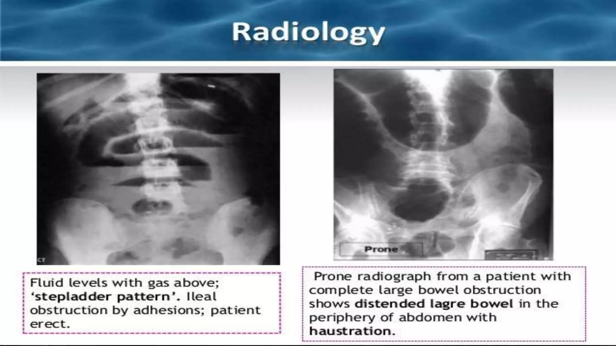 Intestinal obstruction, BOWEL OBSTRUCTION | PPTX