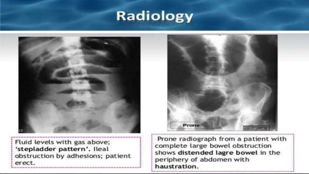INTESTINAL OBSTRUCTION ppt [Autosaved].pptx