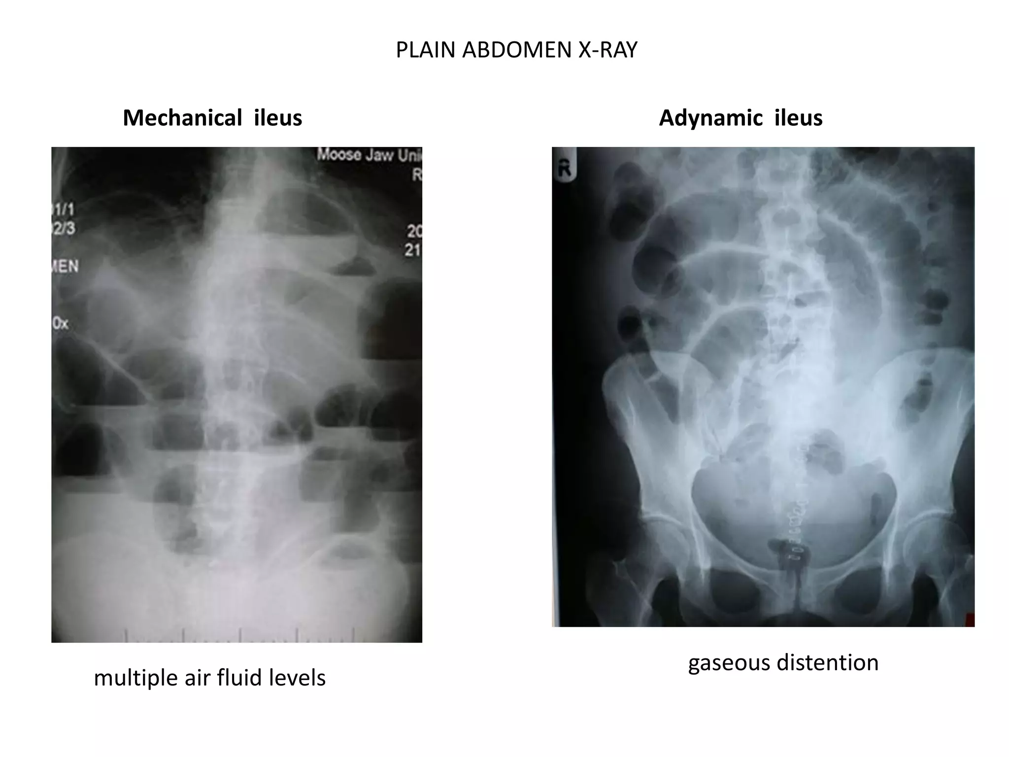 INTESTINAL OCCLUSION.pptx