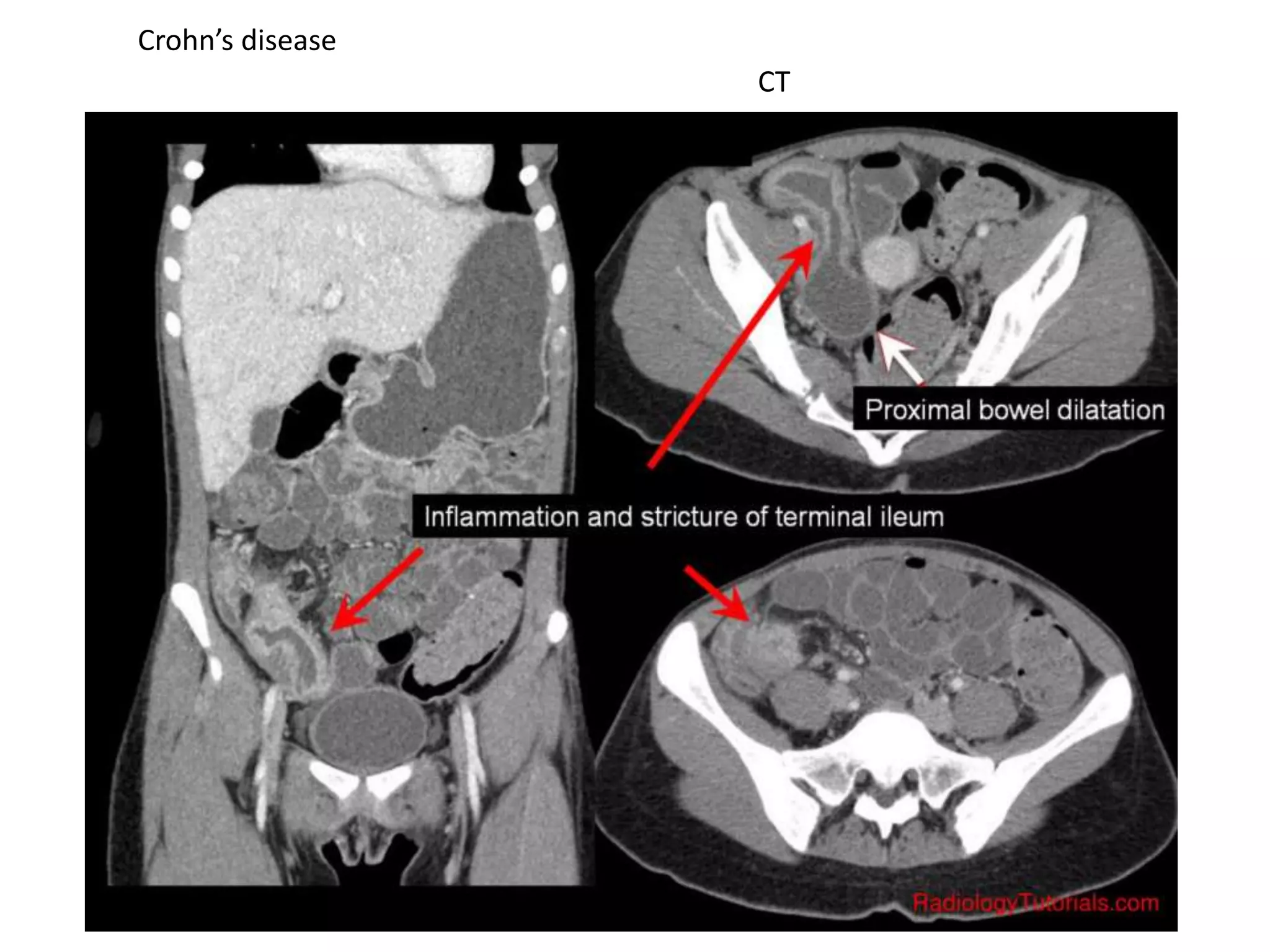 INTESTINAL OCCLUSION.pptx