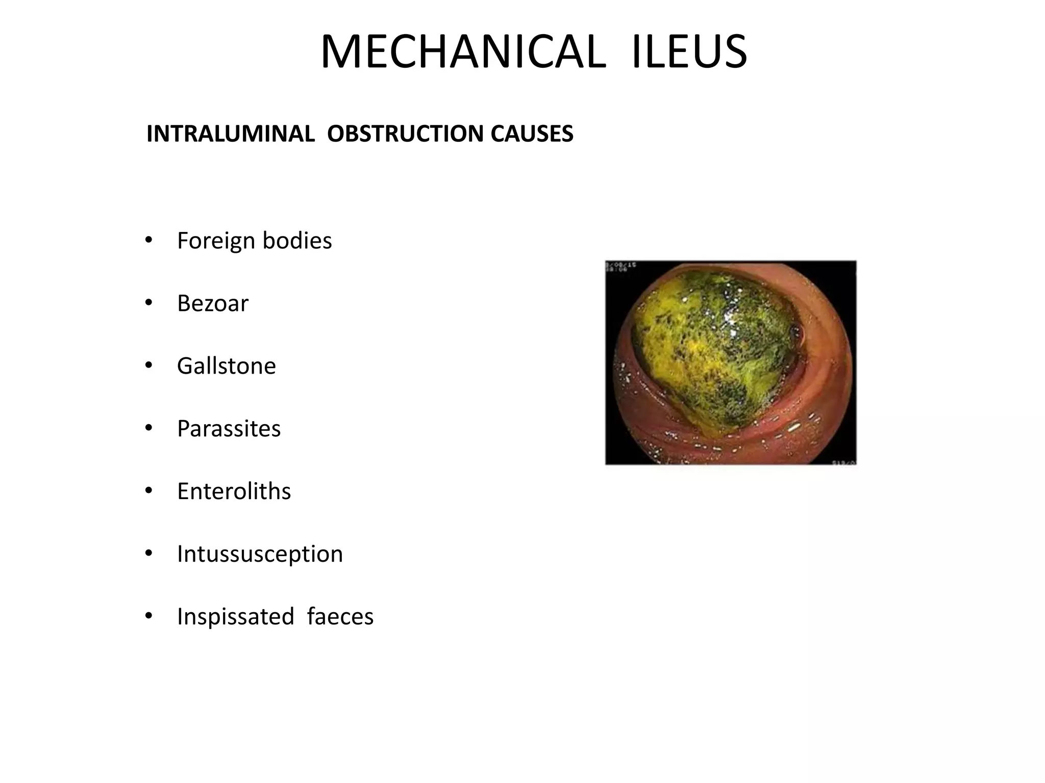 INTESTINAL OCCLUSION.pptx
