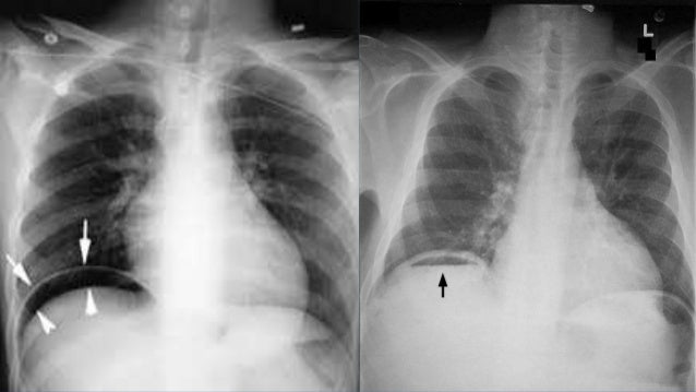 Intestinal perforation