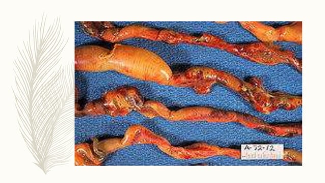 case presentation on Intestinal perforation | PPTX | Pregnancy ...