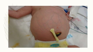 case presentation on Intestinal perforation | PPTX