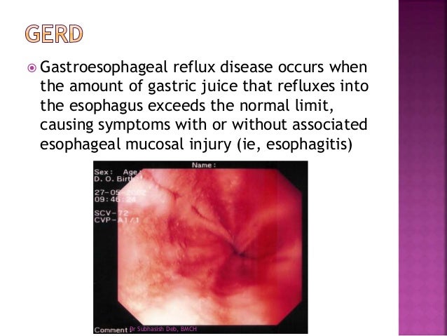 Intestinal peristalsis physiology and motility disorders