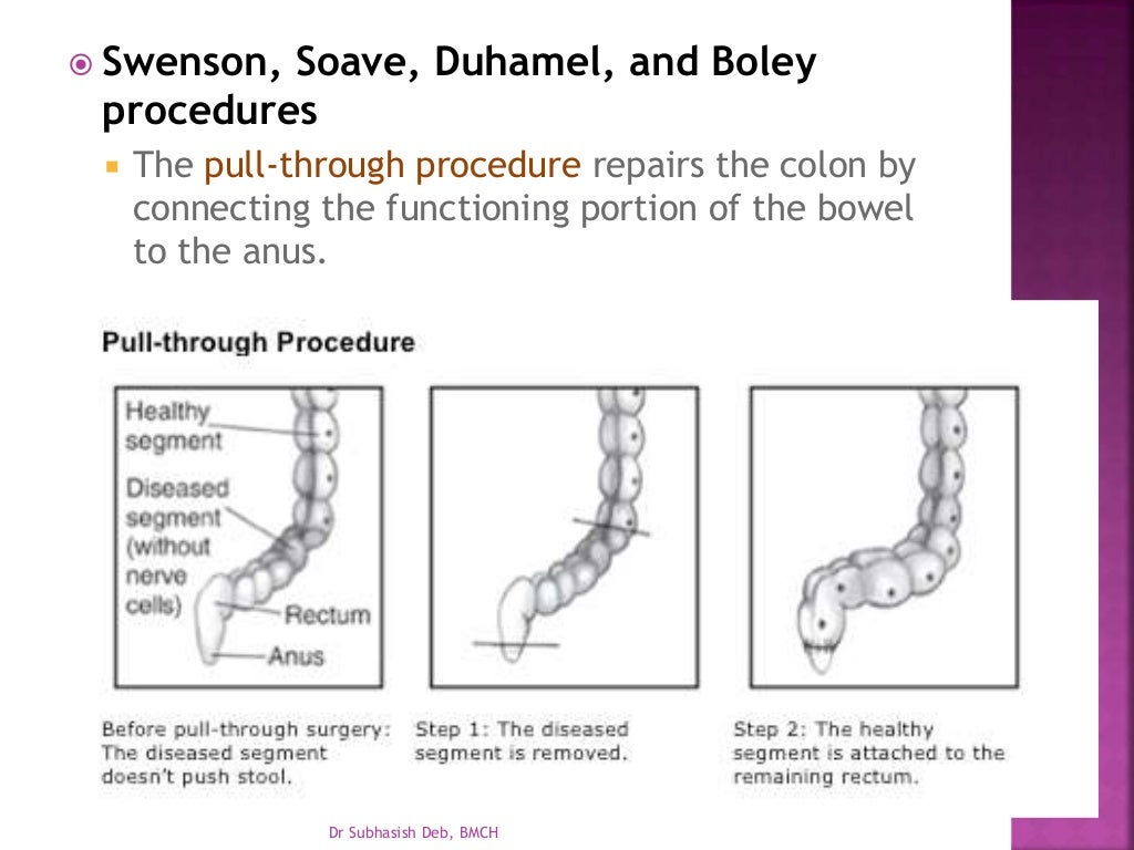 Intestinal peristalsis physiology and motility disorders