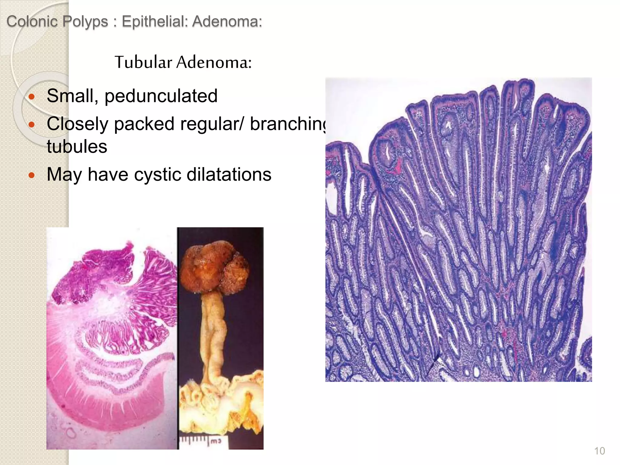 Intestinal polyps | PPTX