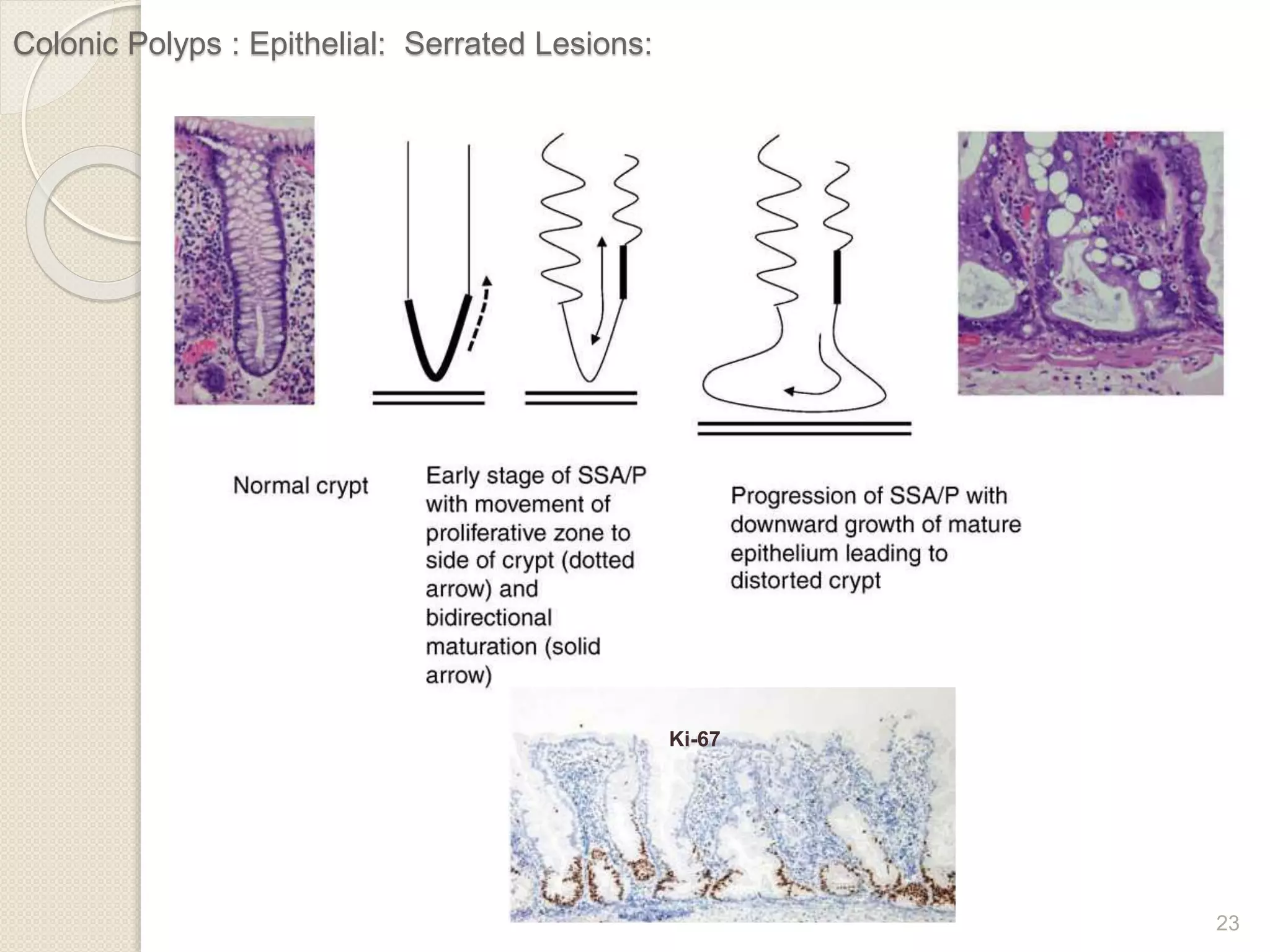 Intestinal polyps | PPTX