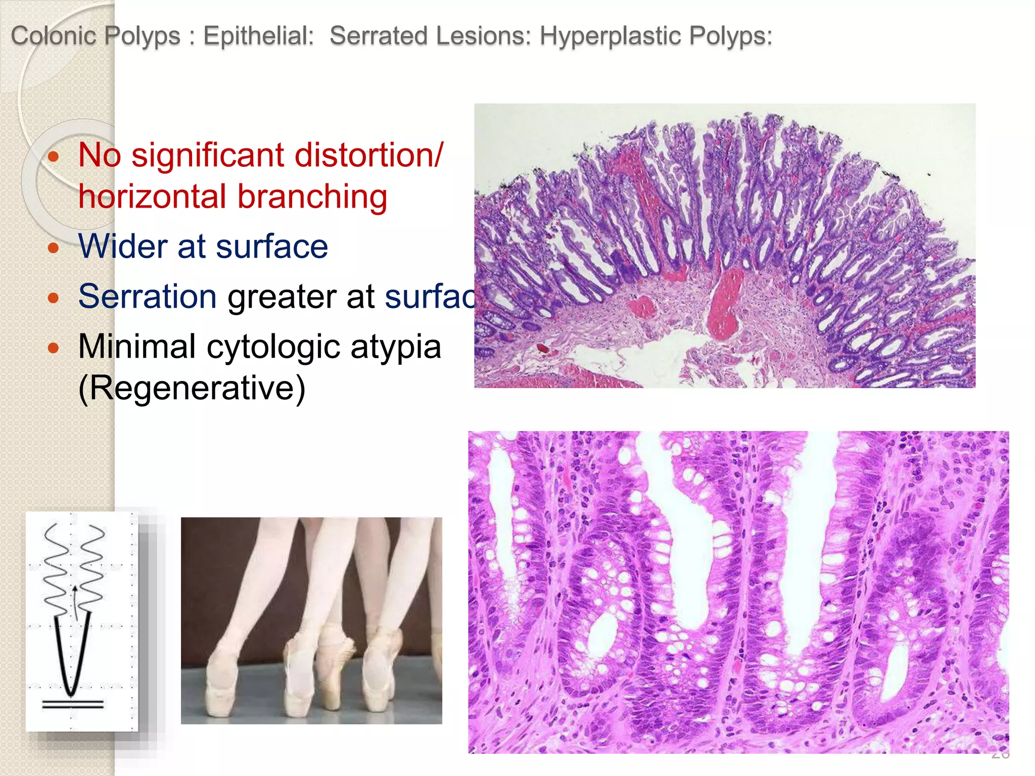 Intestinal polyps | PPTX