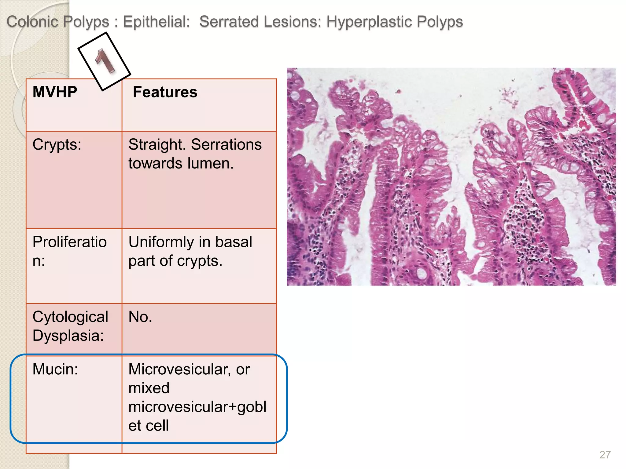 Intestinal polyps | PPTX