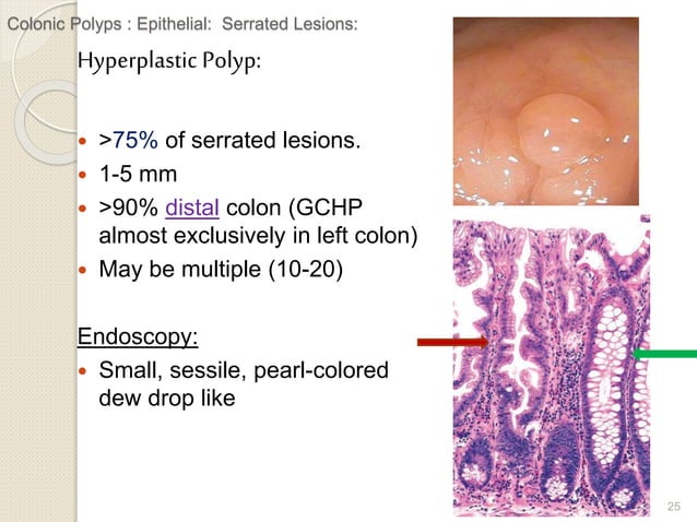 Intestinal polyps | PPTX