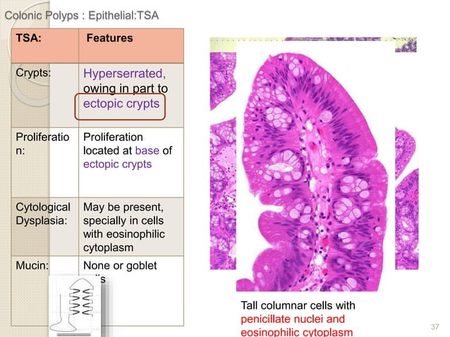Intestinal polyps | PPTX
