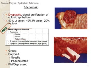 Intestinal polyps | PPTX