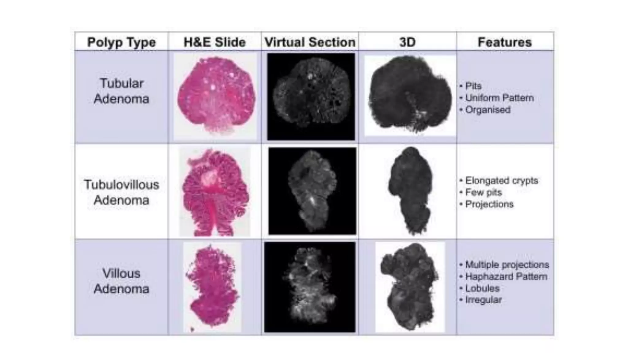 Intestinal polyps | PPTX