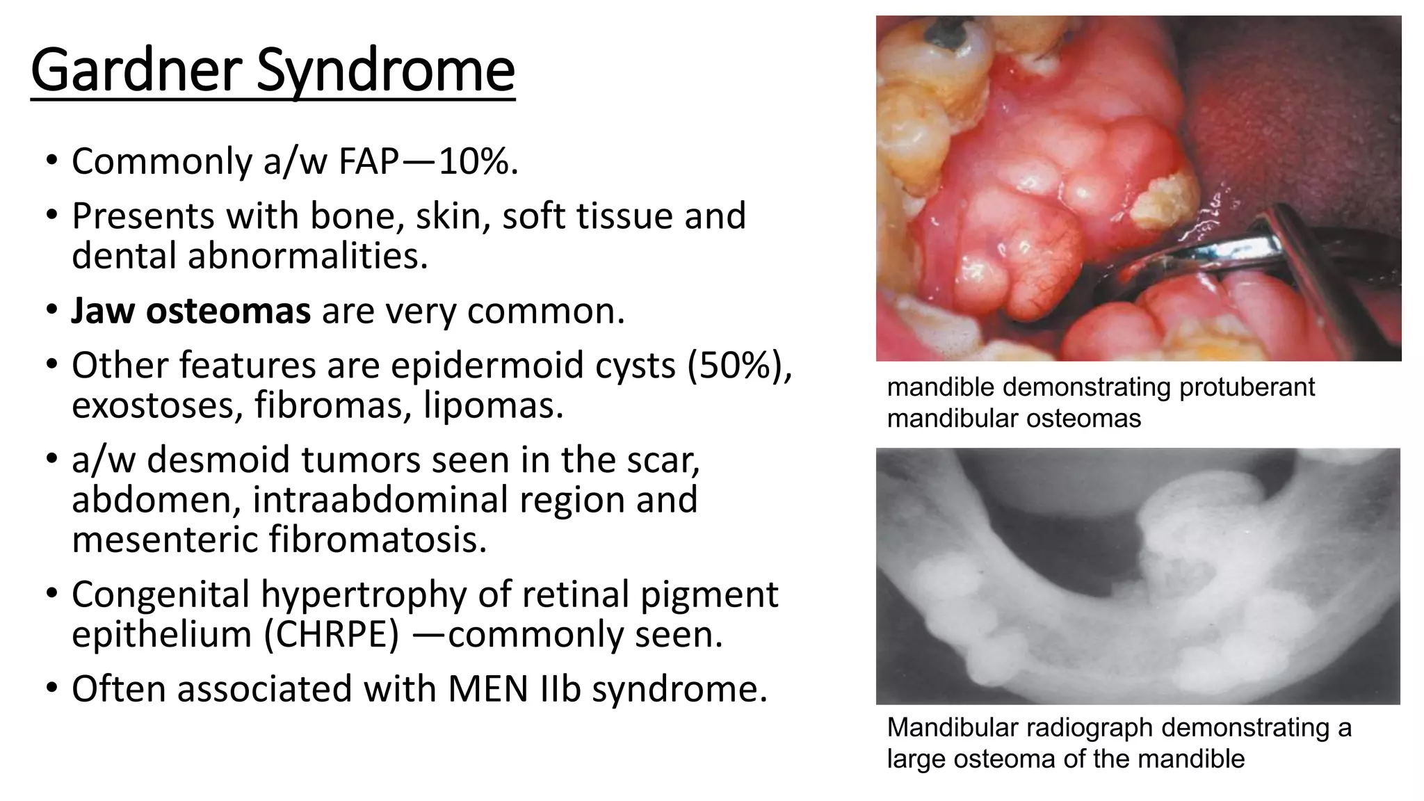 Intestinal polyps | PPTX
