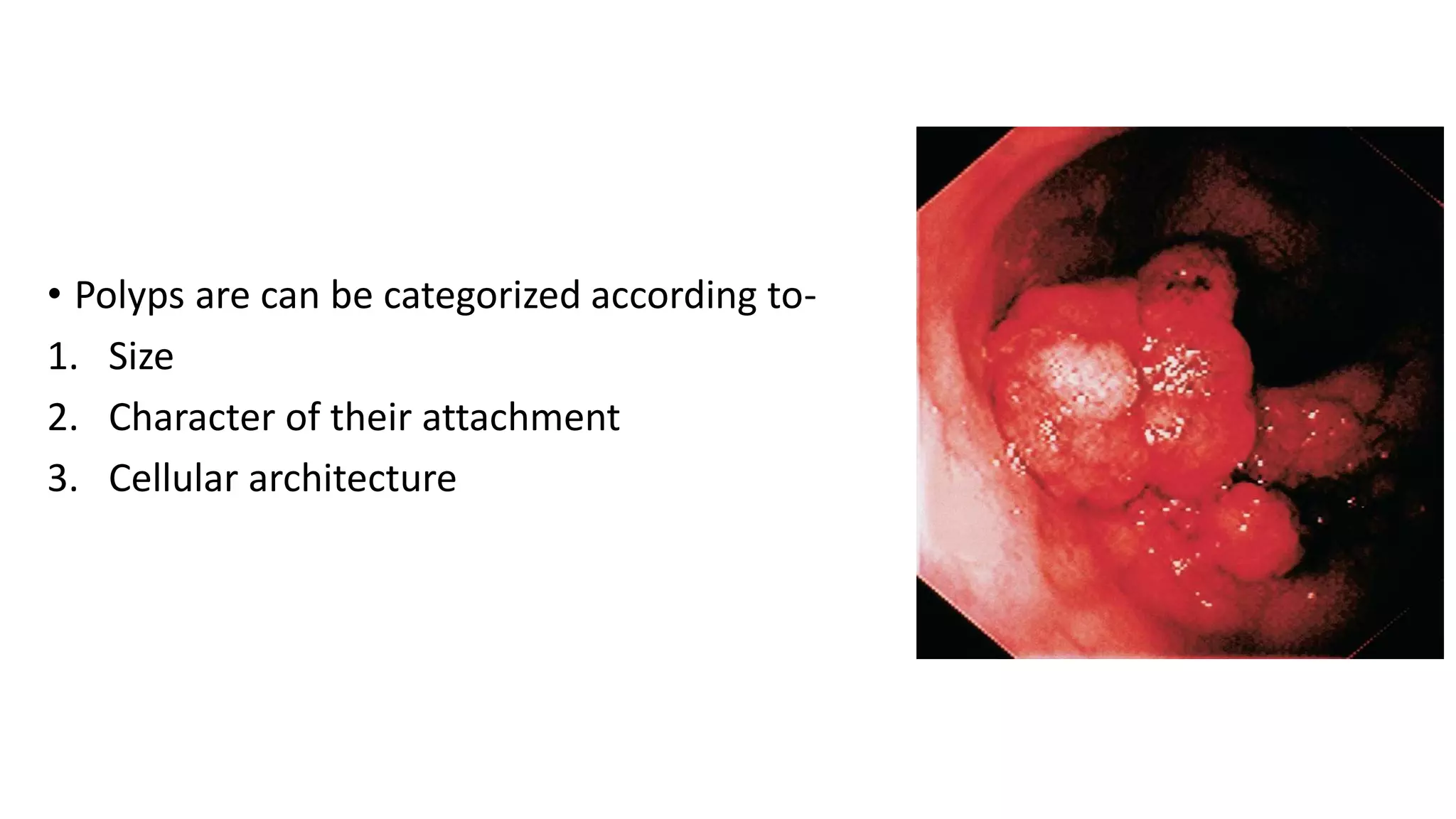 Intestinal polyps | PPTX