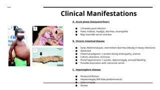 Intestinal Schistosomiasis.pptx clinical presentation | PPTX