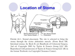 Intestinal stoma( COLOSTOMY) | PPTX