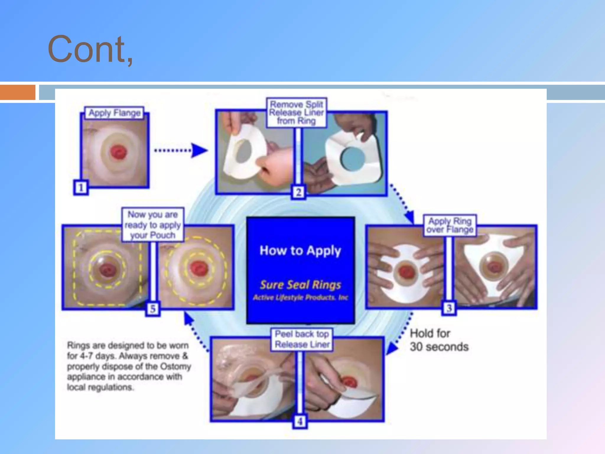 Intestinal stomas | PPT