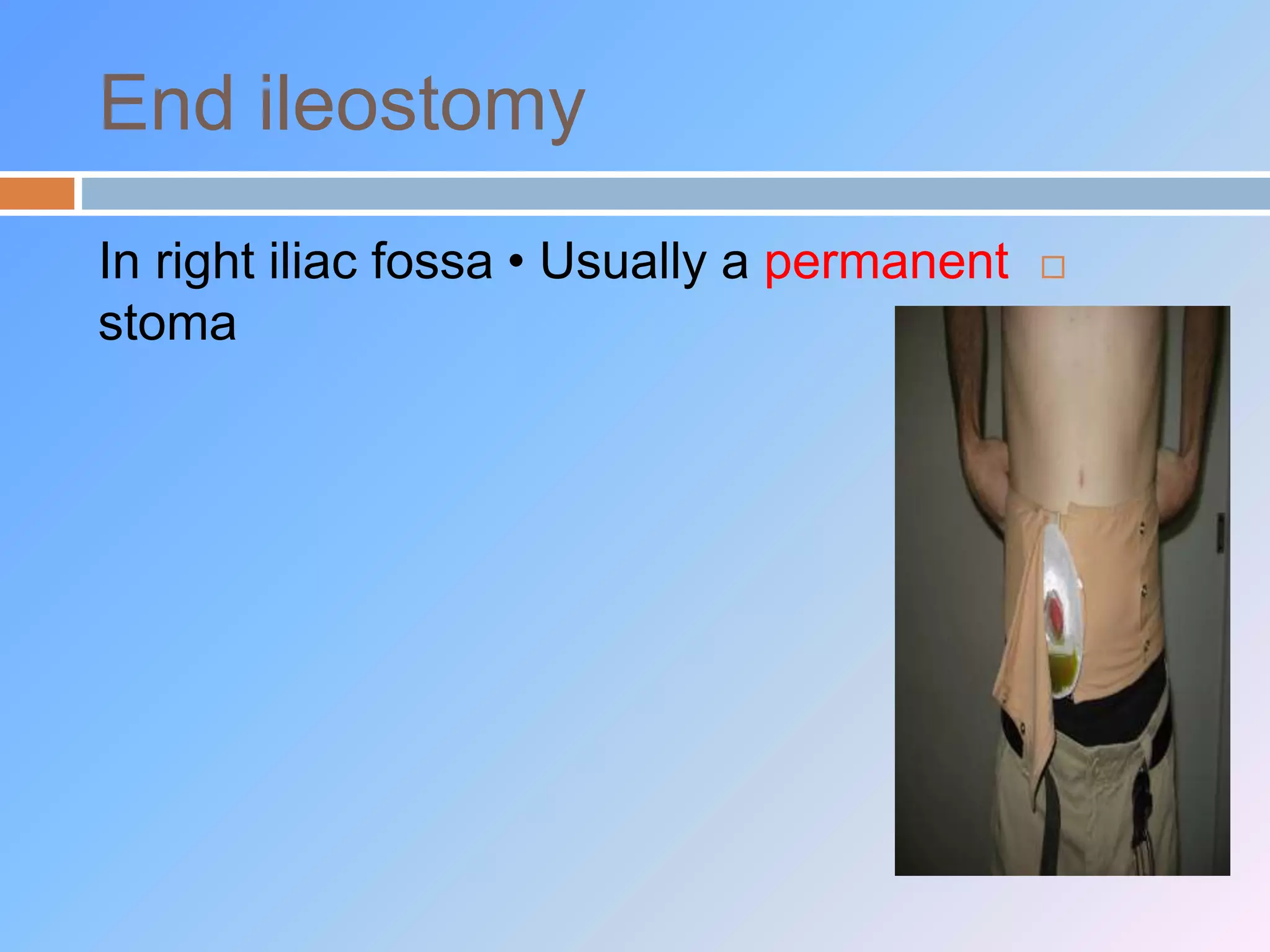 Intestinal stomas | PPTX