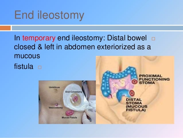 Ileostomy And Mucous Fistula Appendico Vesicocolonic Fistula: A Case