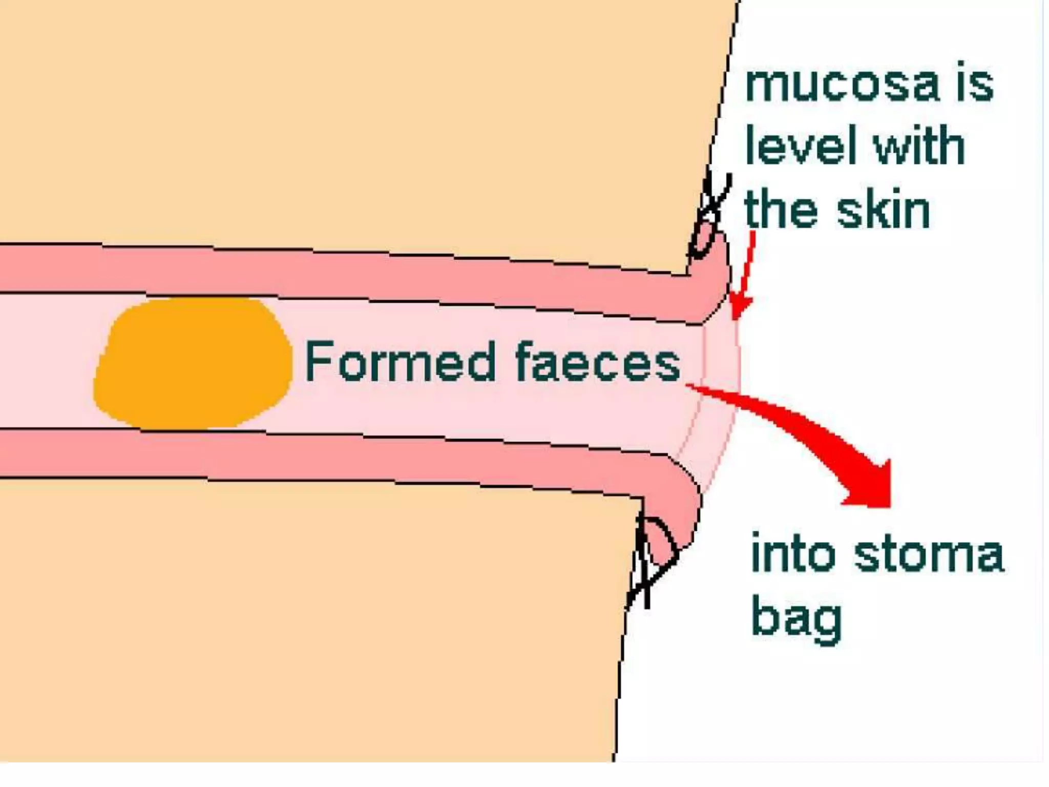 intestinal stomas 07OCT22.pptx