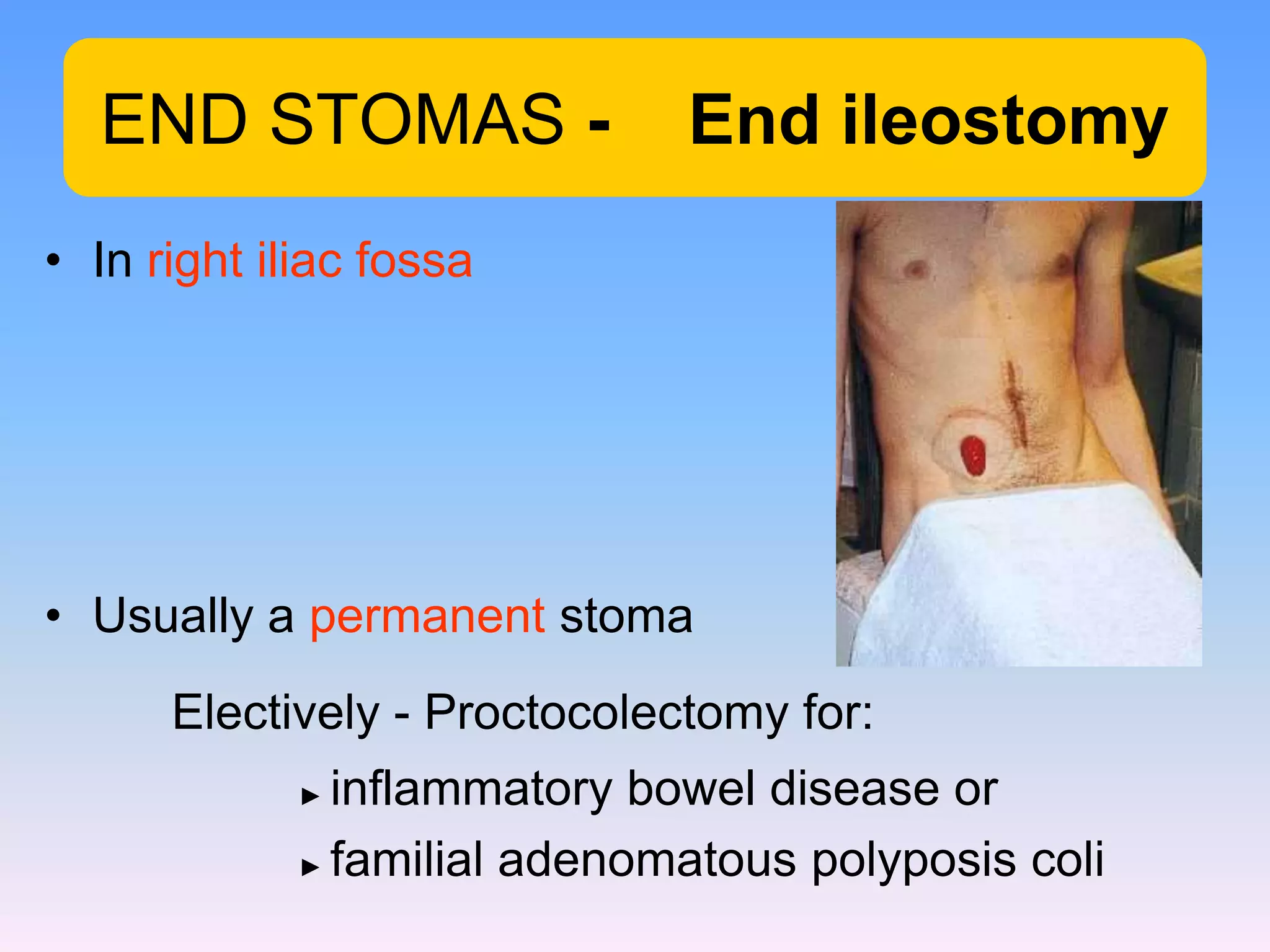 Intestinal stomas | PDF