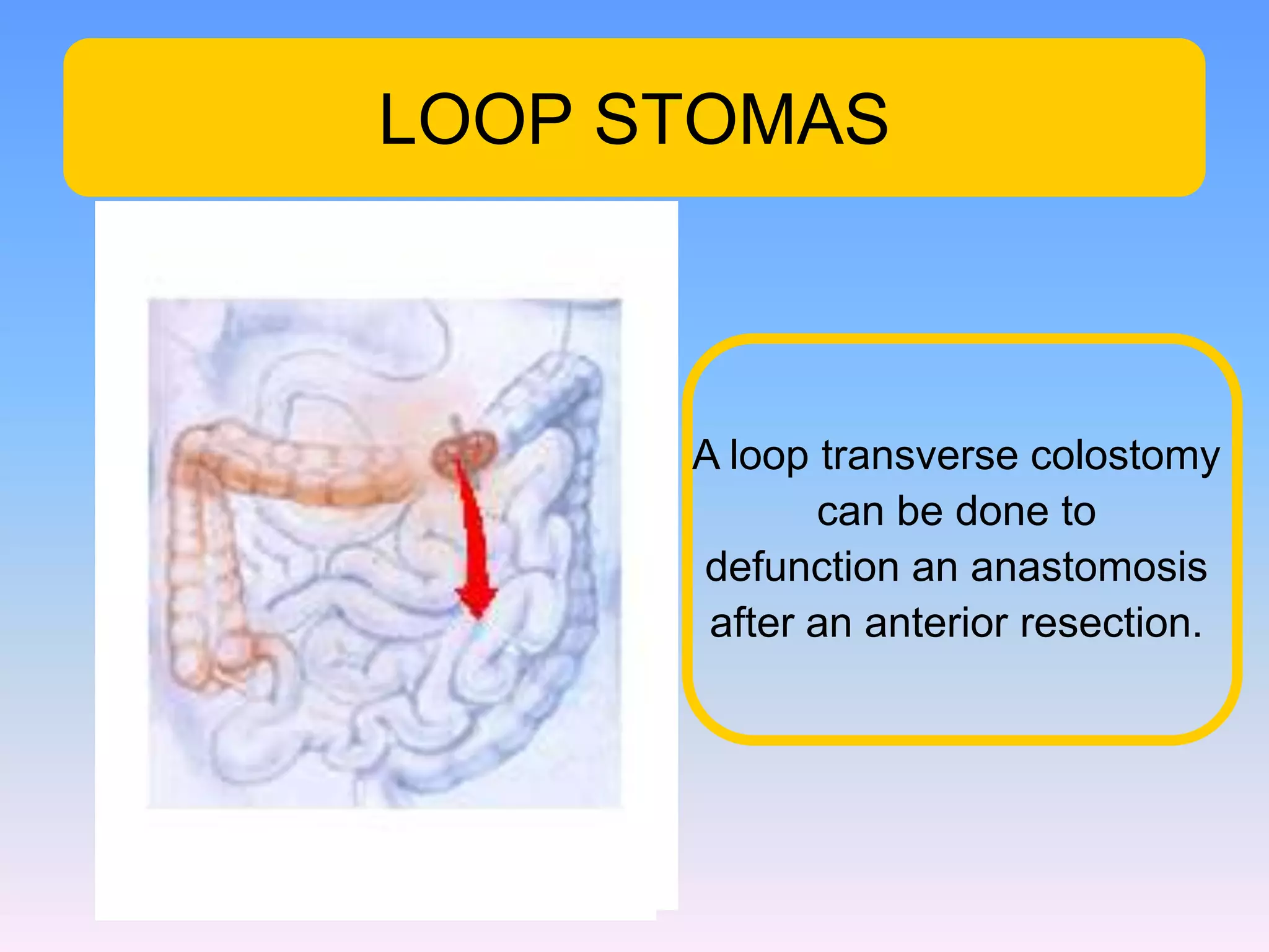 Intestinal stomas | PDF