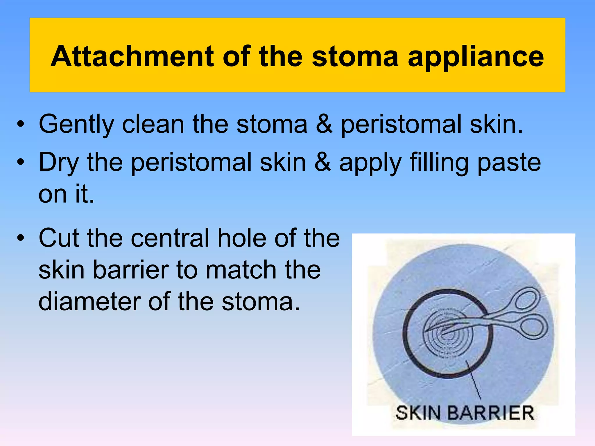 Intestinal stomas | PDF