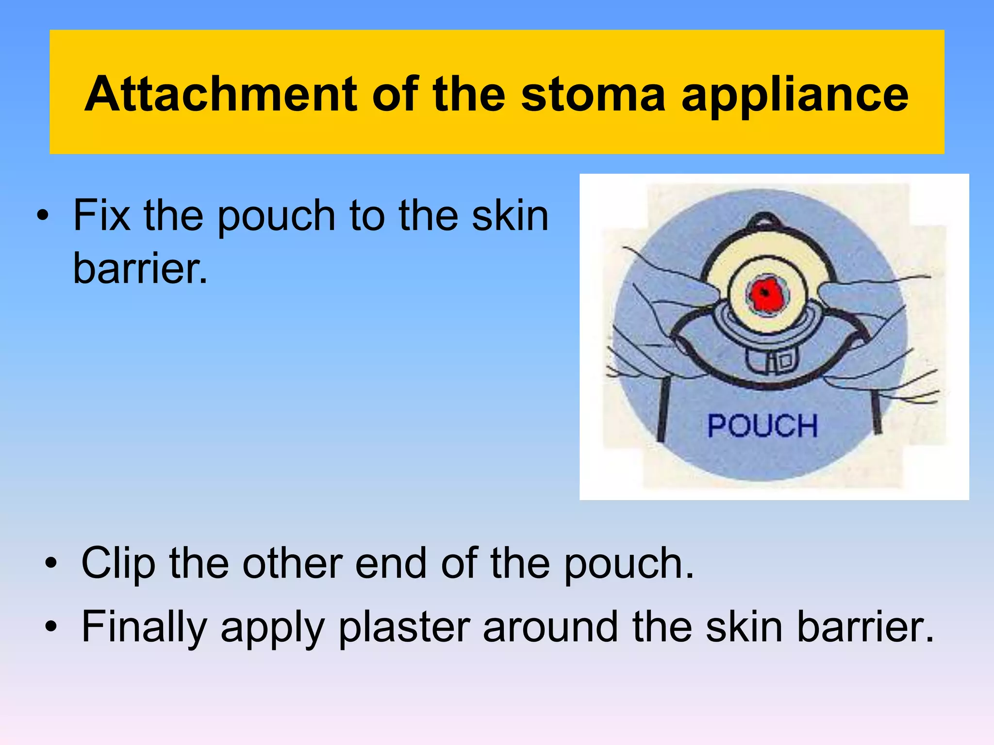 Intestinal stomas | PDF