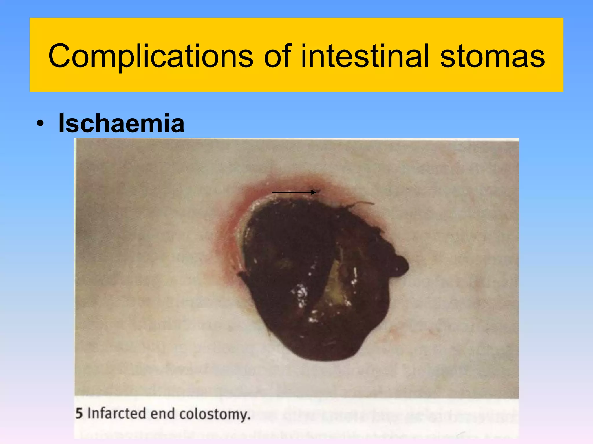 Intestinal stomas | PDF